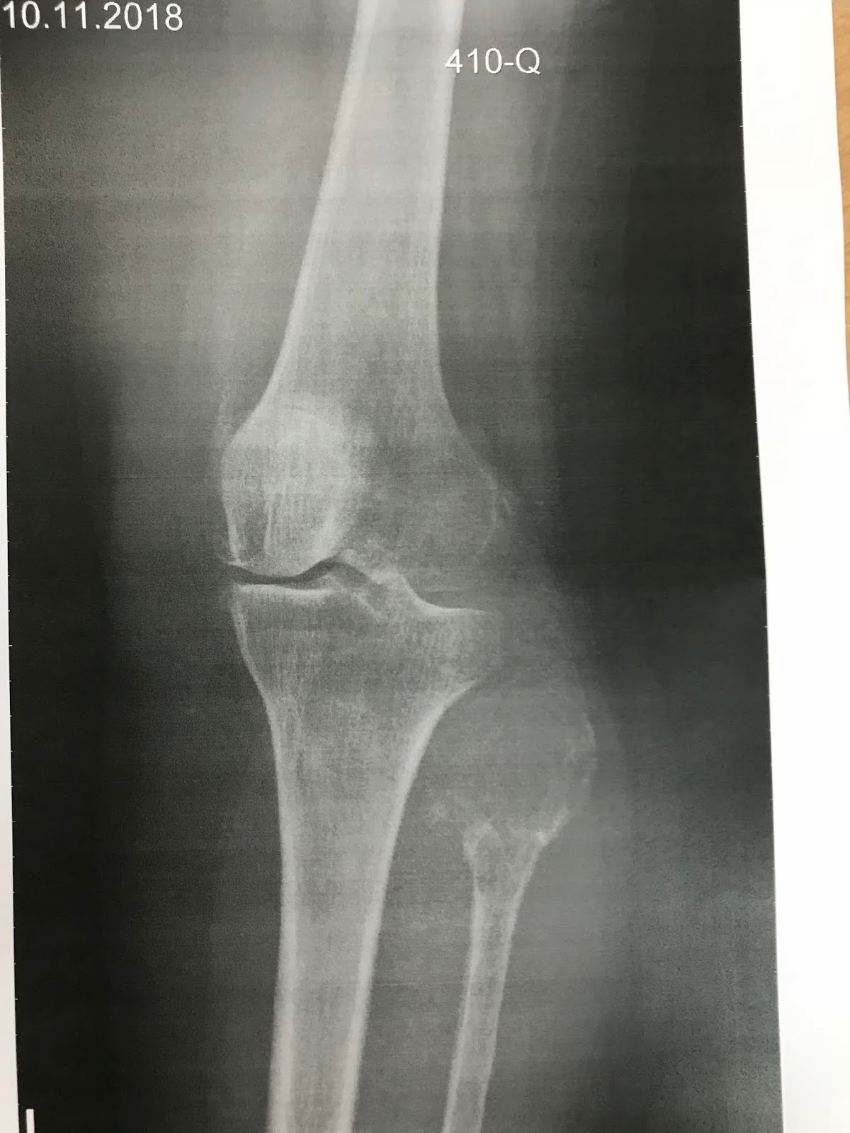 VIETNAMESE MEDIC ULTRASOUND: CASE 523: FIBULAR BONE TUMOR, Dr PHAN ...