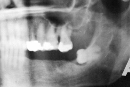 Dentistry and Medicine: Impacted Mandibular 3rd Molar Classification ...