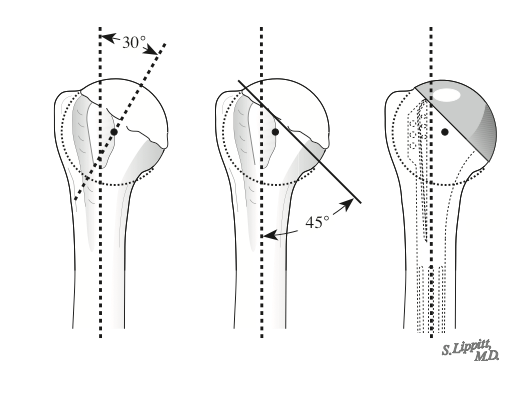 UW Shoulder and Elbow Academy: Shoulder arthroplasty - consideration of ...