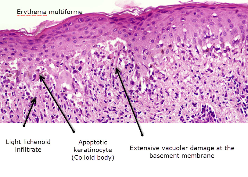 Dermatopathology Made Simple - Inflammatory: Lichenoid / Vacuolar ...