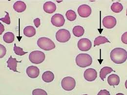 Blog del Laboratorio clinico : Esquistocitos