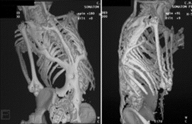 Stone Man Syndrome on emaze