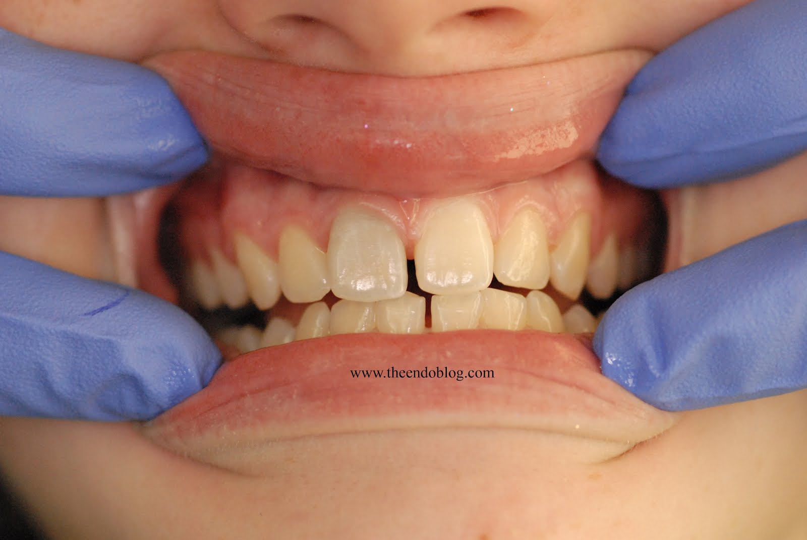 The Endo Blog: Internal bleaching makes us smile!