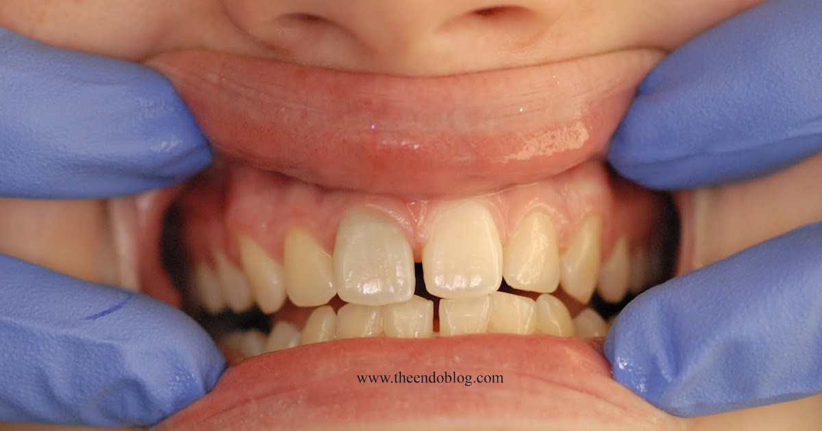 The Endo Blog: Internal bleaching makes us smile!