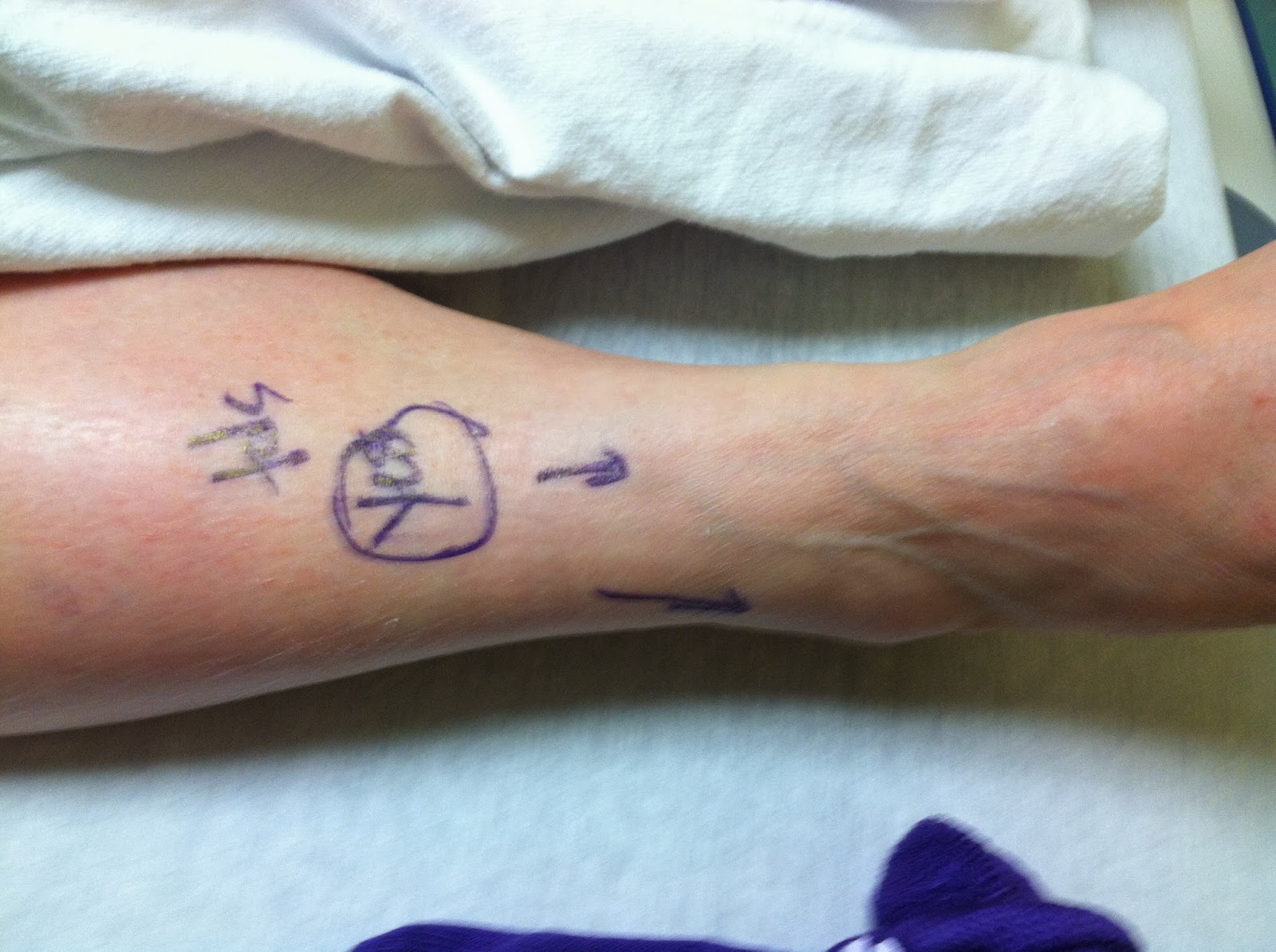 Anne's Tendon Repair Journey: Surgery Day - Peroneal Tendon Surgery