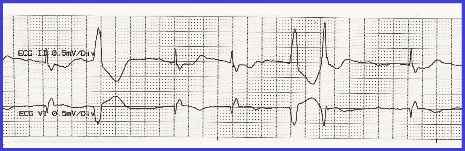 EKG Rhythm Strip Quiz 215