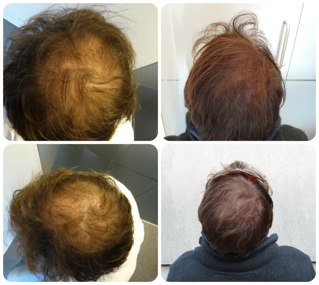 Our first scalp micro pigmentation before and after results