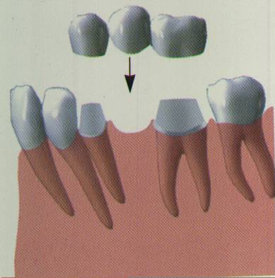 mecanica dental protesis fija: PONTICO CANTILIVER