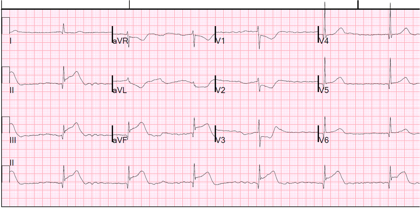 Dr. Smith's ECG Blog: Chest pain and Bradycardia