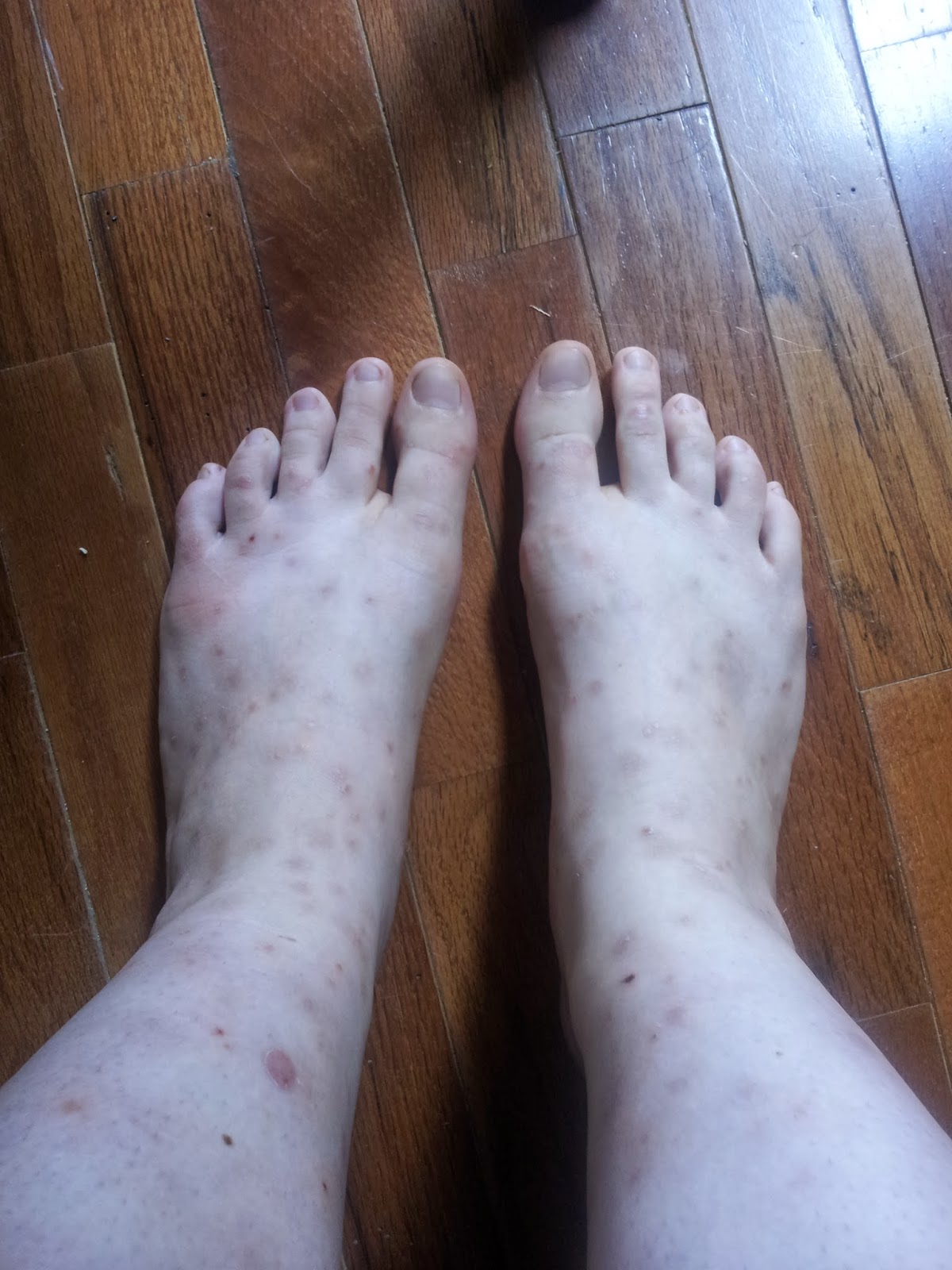 Journey to Personal Freedom: Flea Bites and Essential Oils