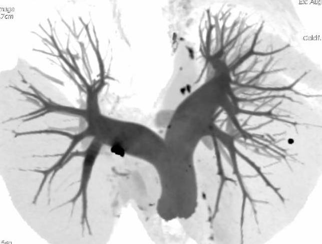 Pulmonary Angiography- Beautiful 128 Slice CT images - Sumer's ...