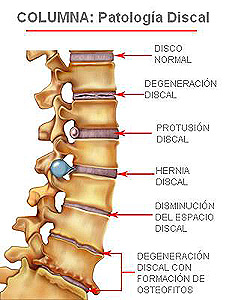 Dr. Jorge Cabrera: El disco intervertebral