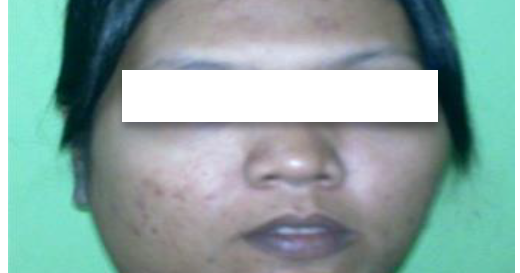 Parotitis ~ Panduan Praktik Klinis Bagi Dokter