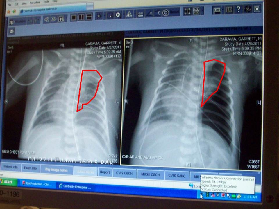 Our CDH Story: Garrett's Little Lungs