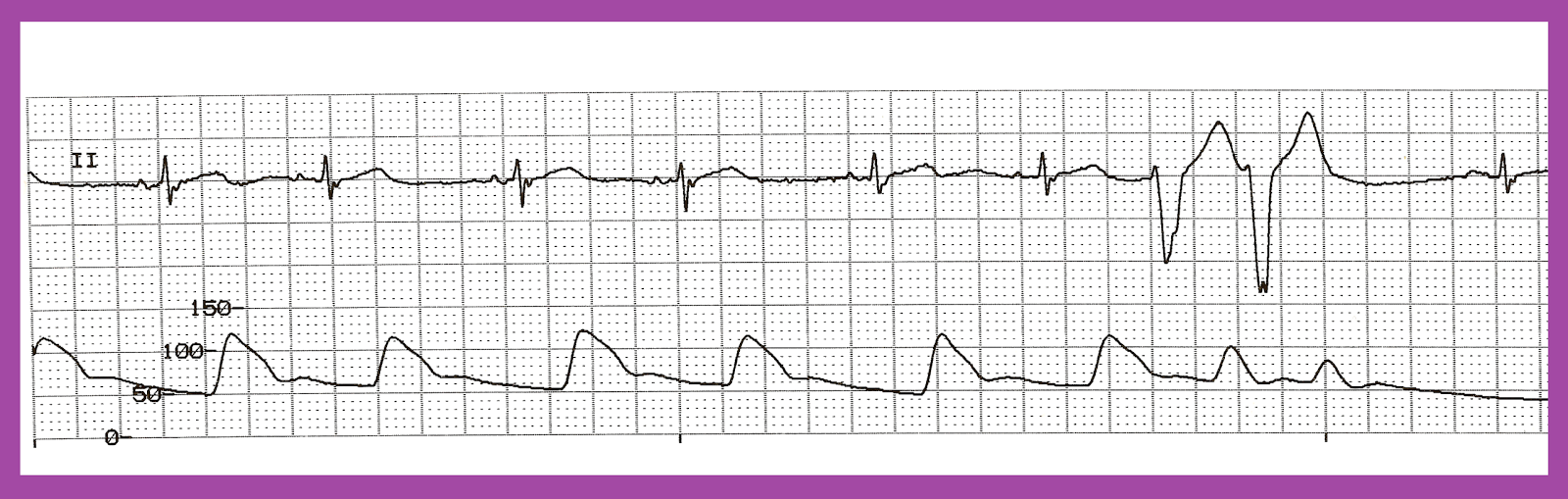 Practice EKG Strips 365