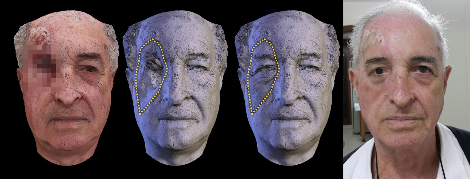 ATOR: Low cost human face prosthesis with the aid of 3D printing