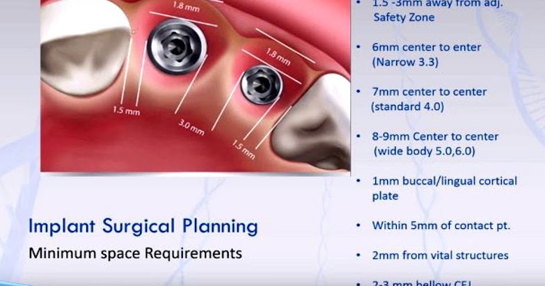 VIDEOCONFERENCING: Computer Guided Implantology In Your Practice ...