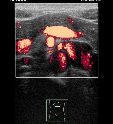 Nutcracker Syndrome-Ultrasound - Sumer's Radiology Blog