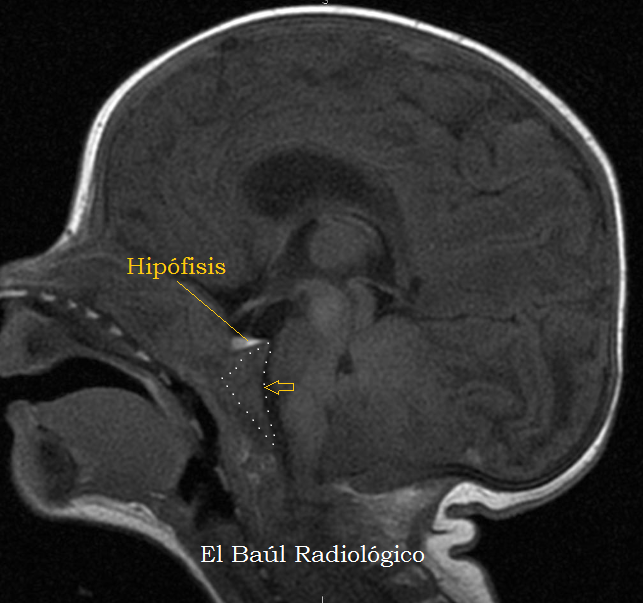 El Baúl Radiológico: SINCONDROSIS ESFENOBASILAR. (Sphenobasilar ...