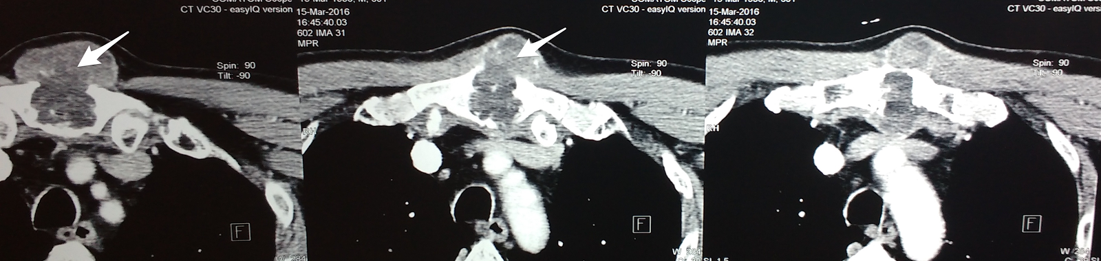 dr pankaj goel: Chondrosarcoma of the Sternum- Radical Excision and ...