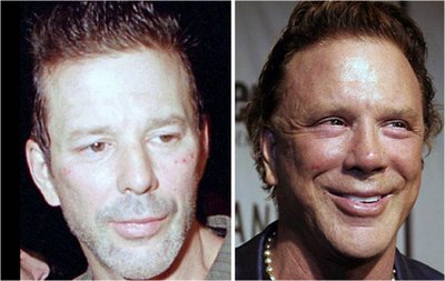 Mickey Rourke Plastic Surgery