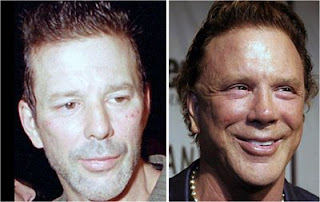 Mickey Rourke Plastic Surgery