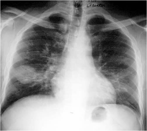 RADIOLOGY IMAGE SPOTTERS: Round pneumonia