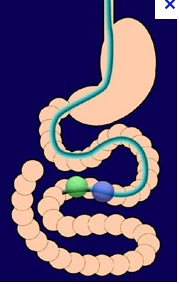 Crohn's Disease Chronicles: Déjà vu