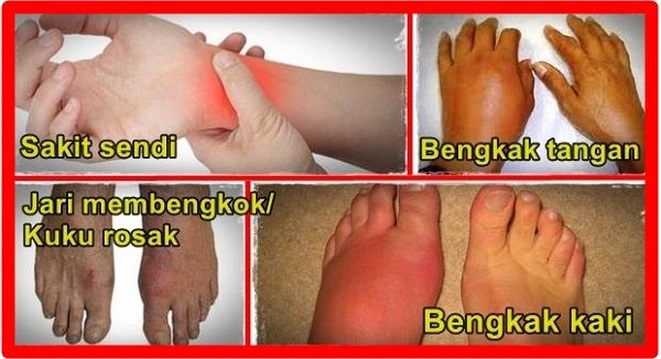 CARA SEMBUHKAN GOUT ~ Natural Health & Beauty. You Worth It.