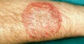 Remedios caseros para eliminar el hongo de tu cuerpo