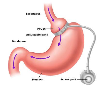 British Surgical Clinic: Adjustable Gastric Banding - Information for ...