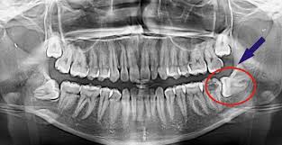 Karen Berkata-kata: Sakit Rahang tidak bisa menutup, TMJ ...