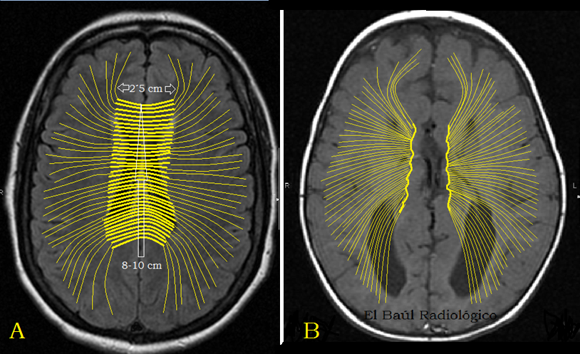 AGENESIA DEL CUERPO CALLOSO PDF
