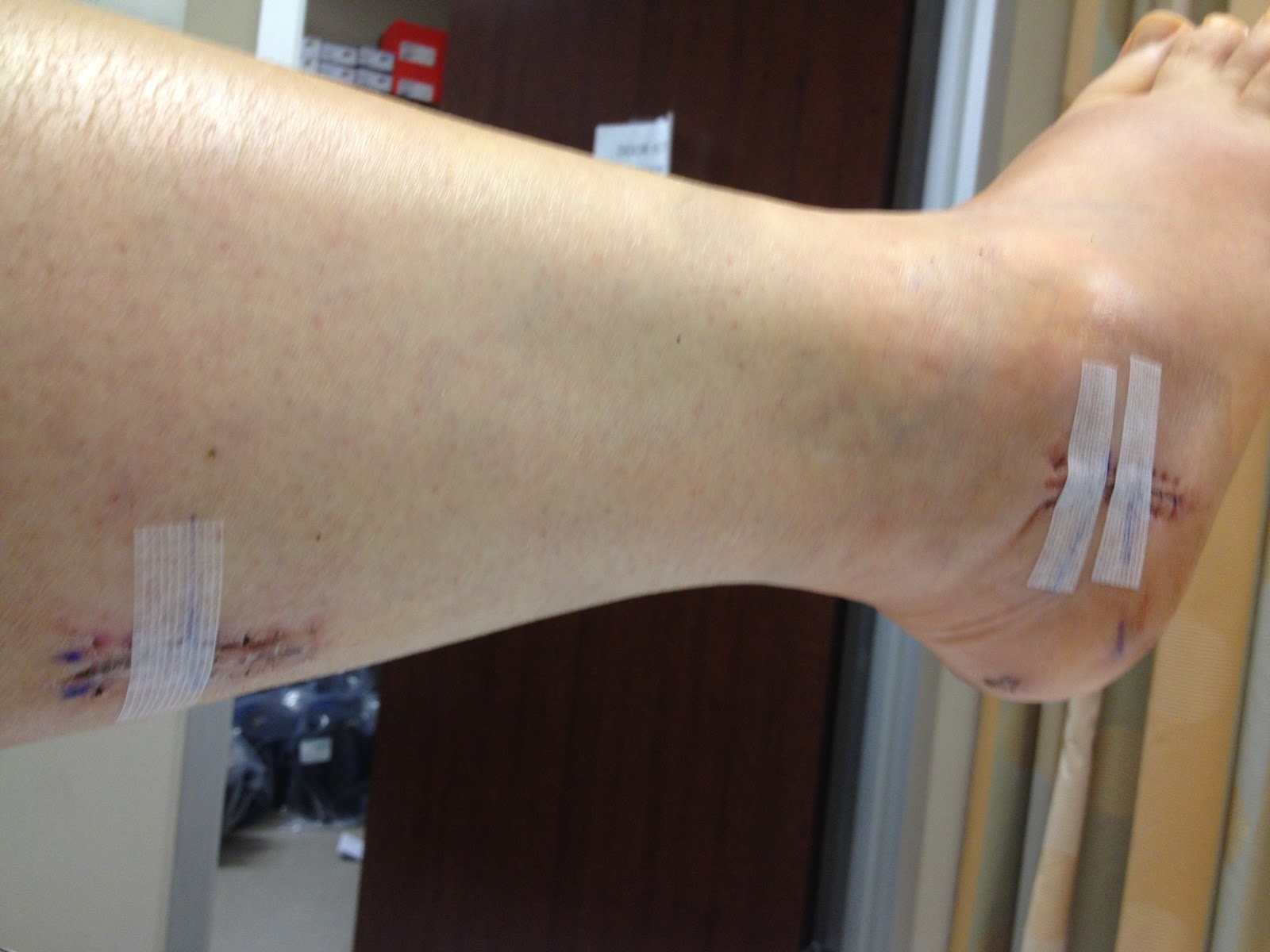 new-steps4ever...recovering from posterior tibial tendon injury : Shedding