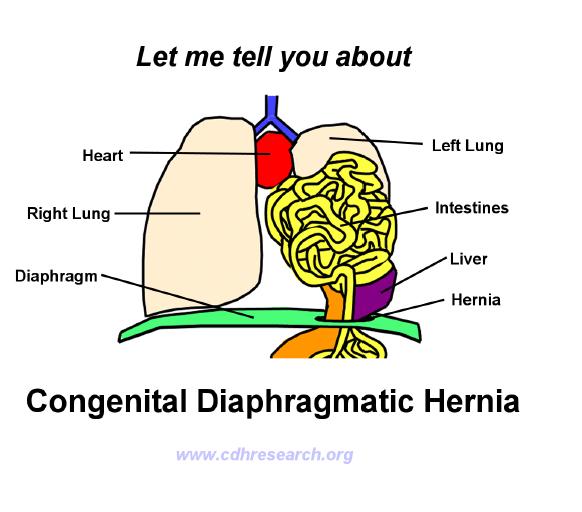 CHERUBS Oregon - Congenital Diaphragmatic Hernia (CDH): What is CDH?