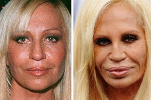 10 famosas adictas al Botox | D TRES Agencia
