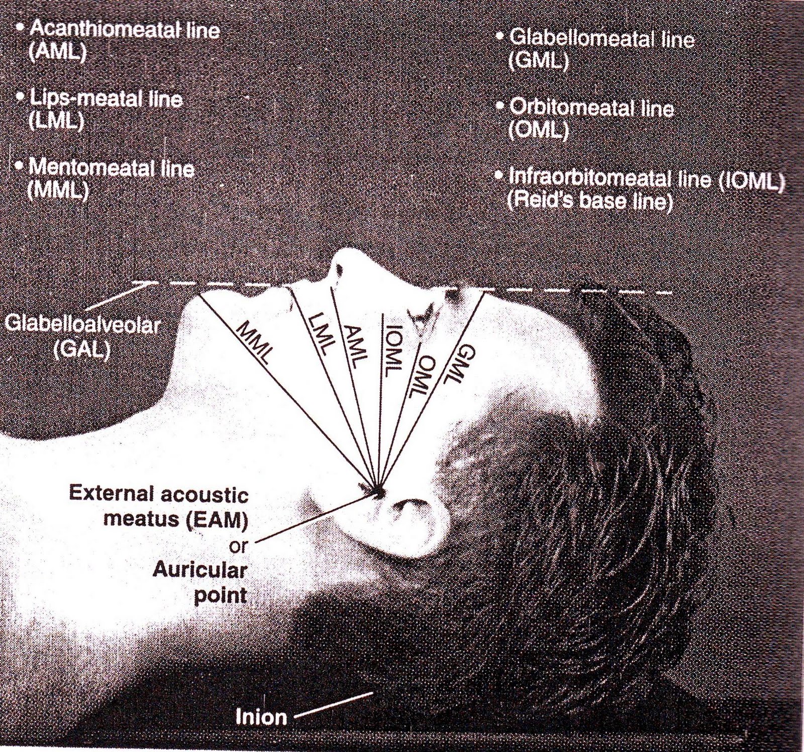 Teknik Radiograf: Teknik Radiografi Pada Pasien Polip Nasal