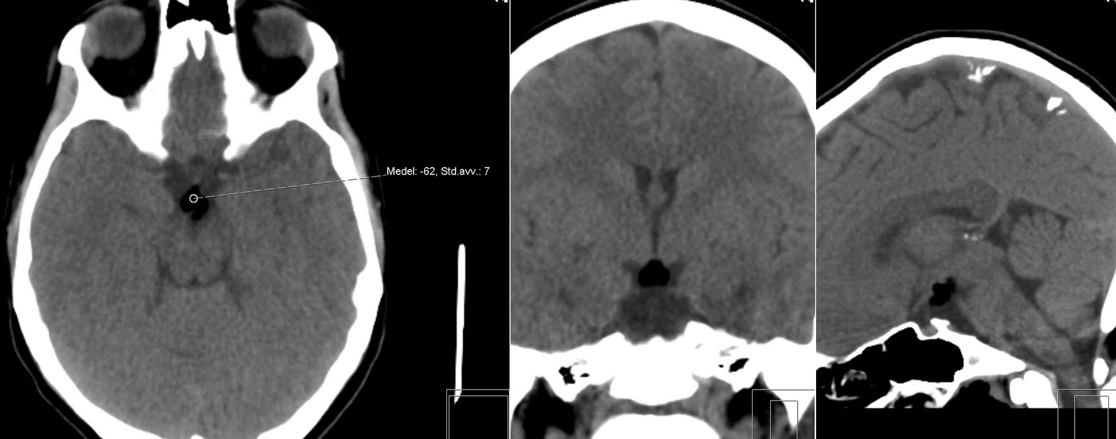 Hypothalamic Lipoma