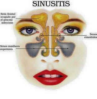 ANDA MENGIDAP SINUSITIS ??? TERAPI DENGAN MILAGROS - Herni Stokis ...