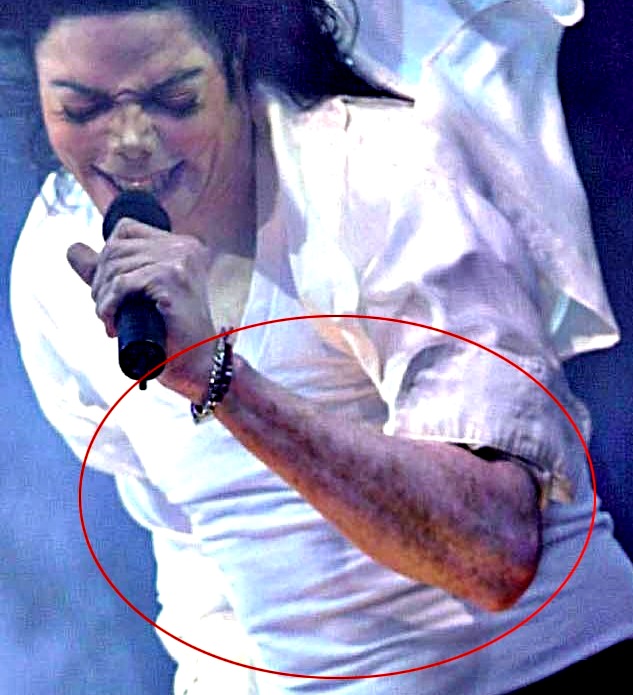 Cartas para Michael: Lúpus e vitiligo, dois desafios para Michael Jackson