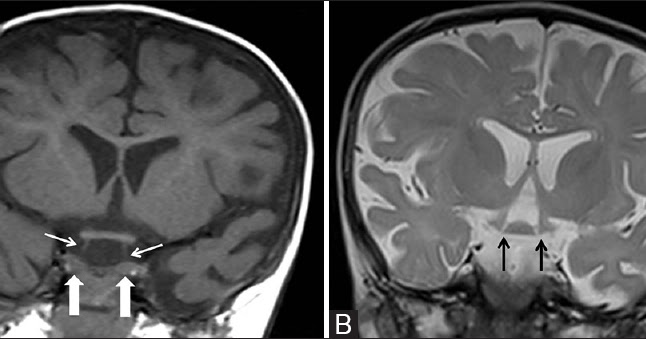 pediatric neurology: Duplication of the pituitary gland - plus syndrome