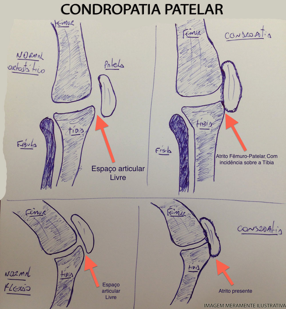 S.T.A.F. Explica - Condropatia Patelar