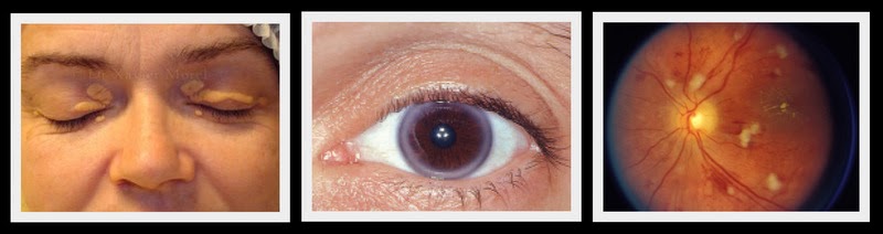 Memphis Family Vision: Ocular Signs of Heart Disease