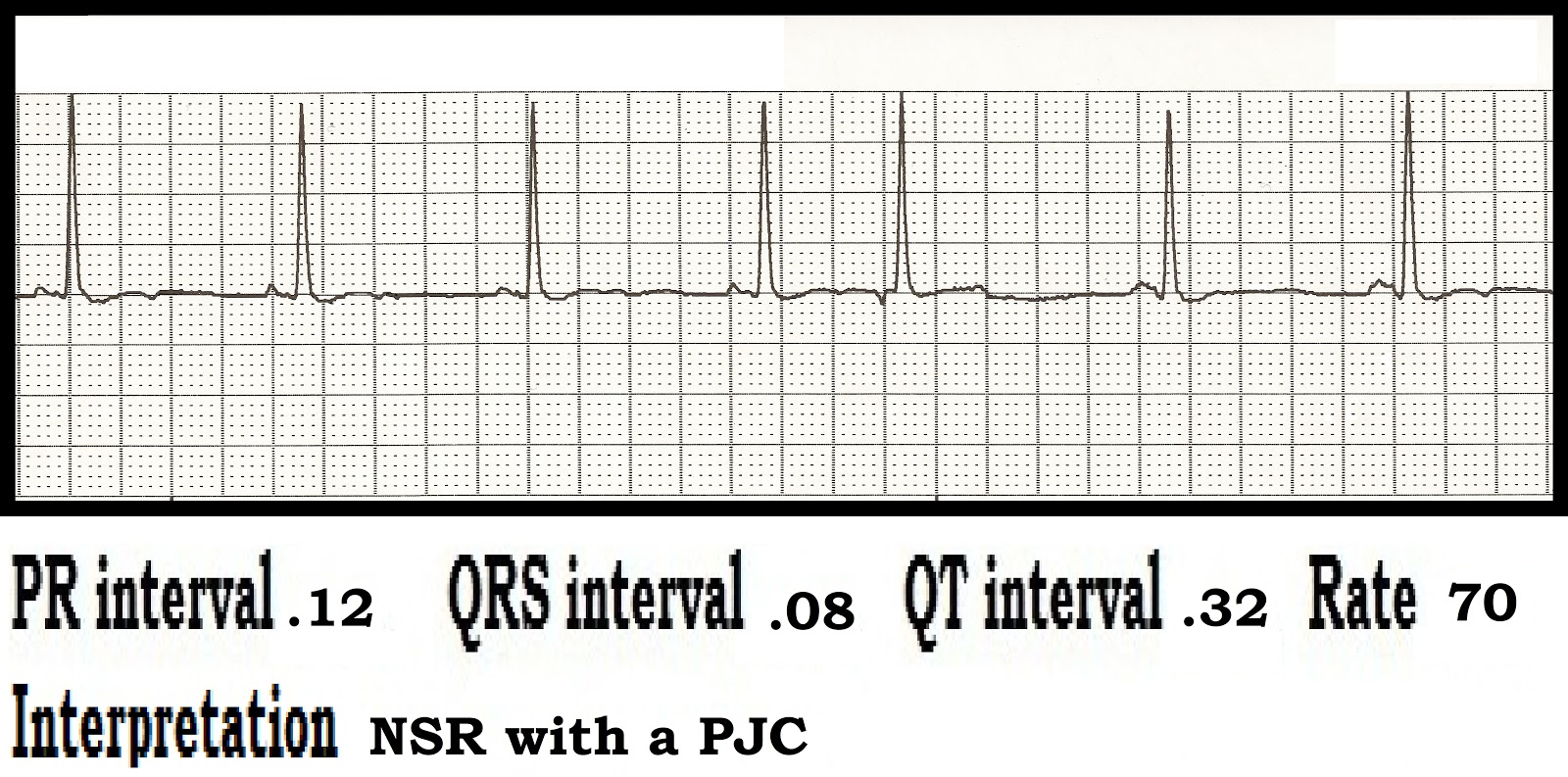 ECG Rhythm Strip Quiz 91: Interval measurements
