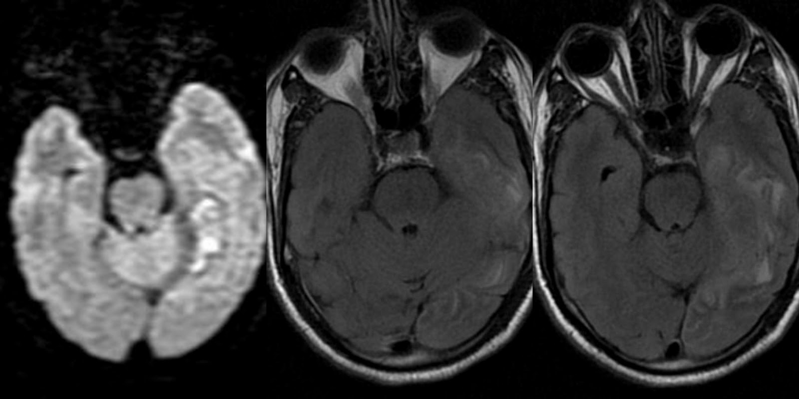 Dr Balaji Anvekar FRCR: Subdural Empyema - Abscess
