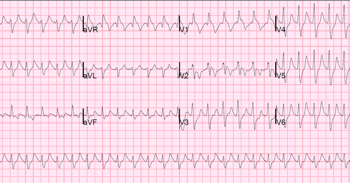 Dr. Smith's ECG Blog: Right Bundle Branch Block with ST Elevation in V1?