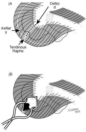 UW Shoulder and Elbow Academy: Rotator Cuff 14 - Partial thickness ...