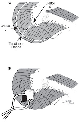 UW Shoulder and Elbow Academy: Rotator Cuff 14 - Partial thickness ...