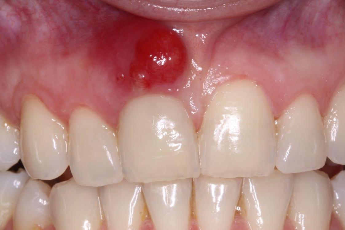 Alternativní Doktorka: Abces (Hnisavý váček) na dásni u dítěte