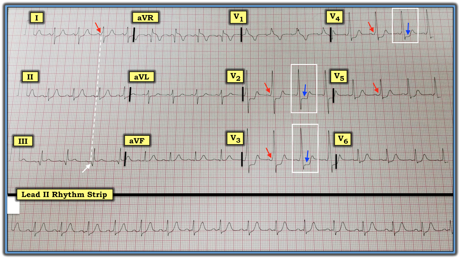 ECG Interpretation